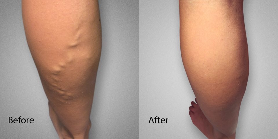 Before & After Photos l Advanced Varicose Vein Treatments of Manhattan NYC