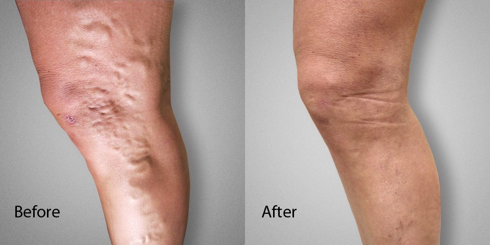Before & After Photos l Advanced Varicose Vein Treatments of Manhattan NYC
