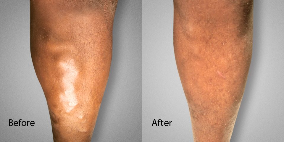 Before & After Photos l Advanced Varicose Vein Treatments of Manhattan NYC