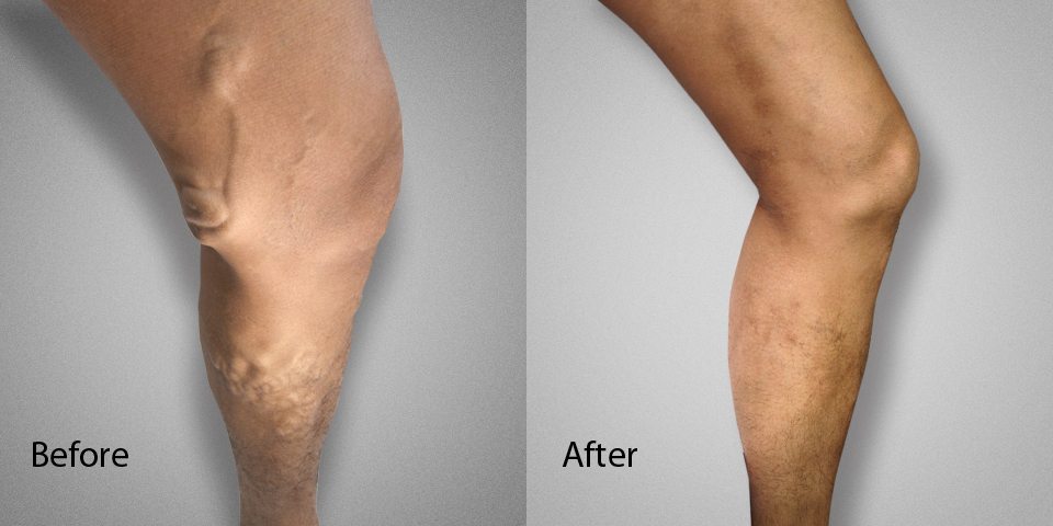 Before & After Photos l Advanced Varicose Vein Treatments of Manhattan NYC