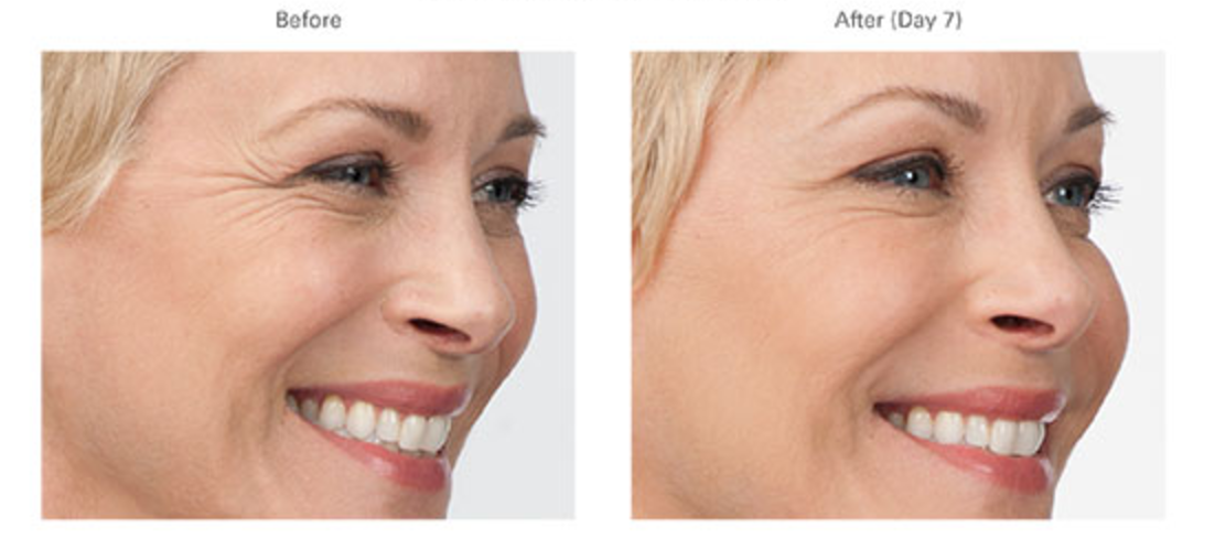 Botox Injections Manhattan | Injectable Dermal Fillers NYCTreatments of ...