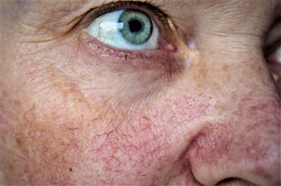 Facial Veins | Varicose Vein Treatment NYCTreatments of Manhattan